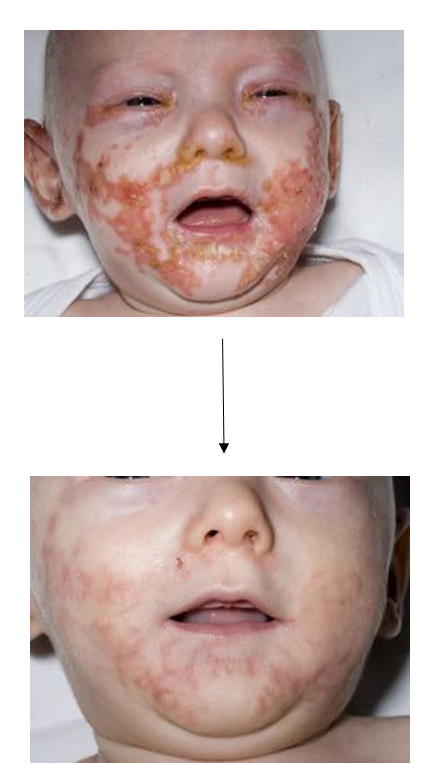 Acrodermatitis enteropathica (AE) – Remdii